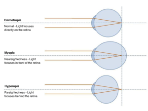 refractive errors - Bright Vision Optometry | Chino Hills, CA 91709 ...
