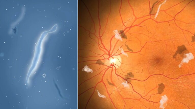 this is what eye floaters are - Bright Vision Optometry | Chino Hills ...